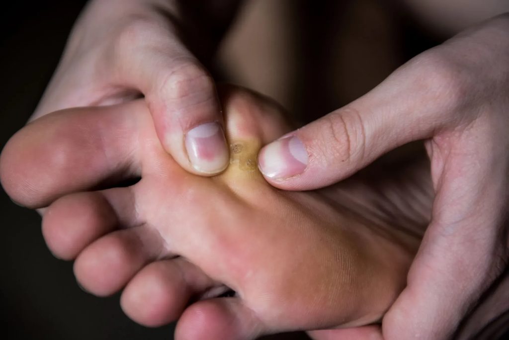 Corns Treated in Upland | Family Foot and Ankle Center